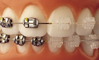 ¿Cómo funcionan los brackets de ortodoncia? - Clínica Birbe