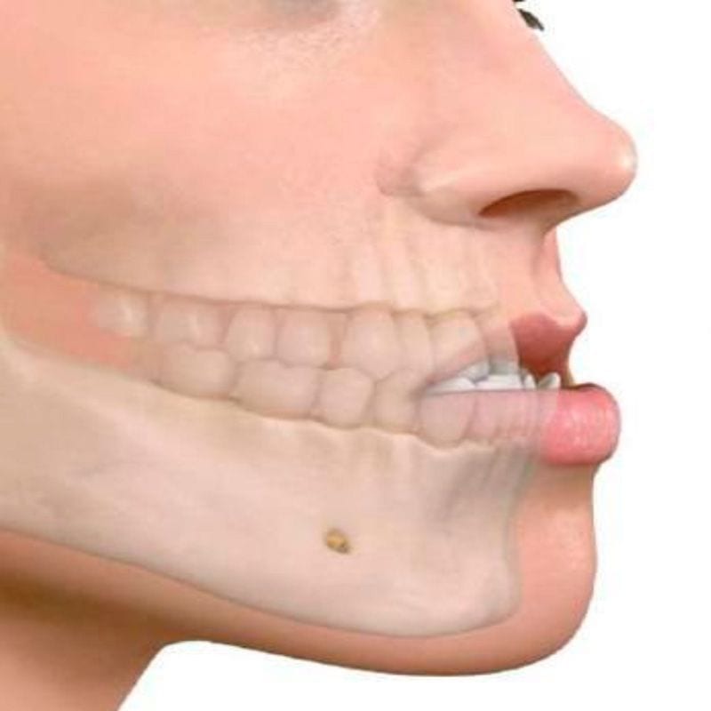 Cómo detectar el prognatismo mandibular en niños | Clínica Birbe