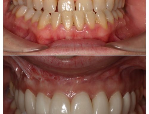 ¿ Que son los torus? | | Clínica Birbe
