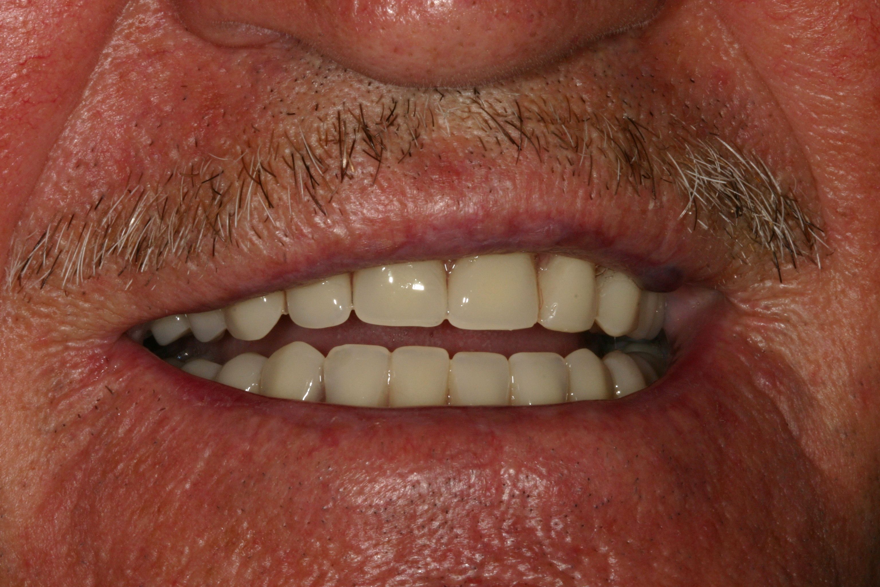 Prótesis total sobre implantes | | Clínica Birbe