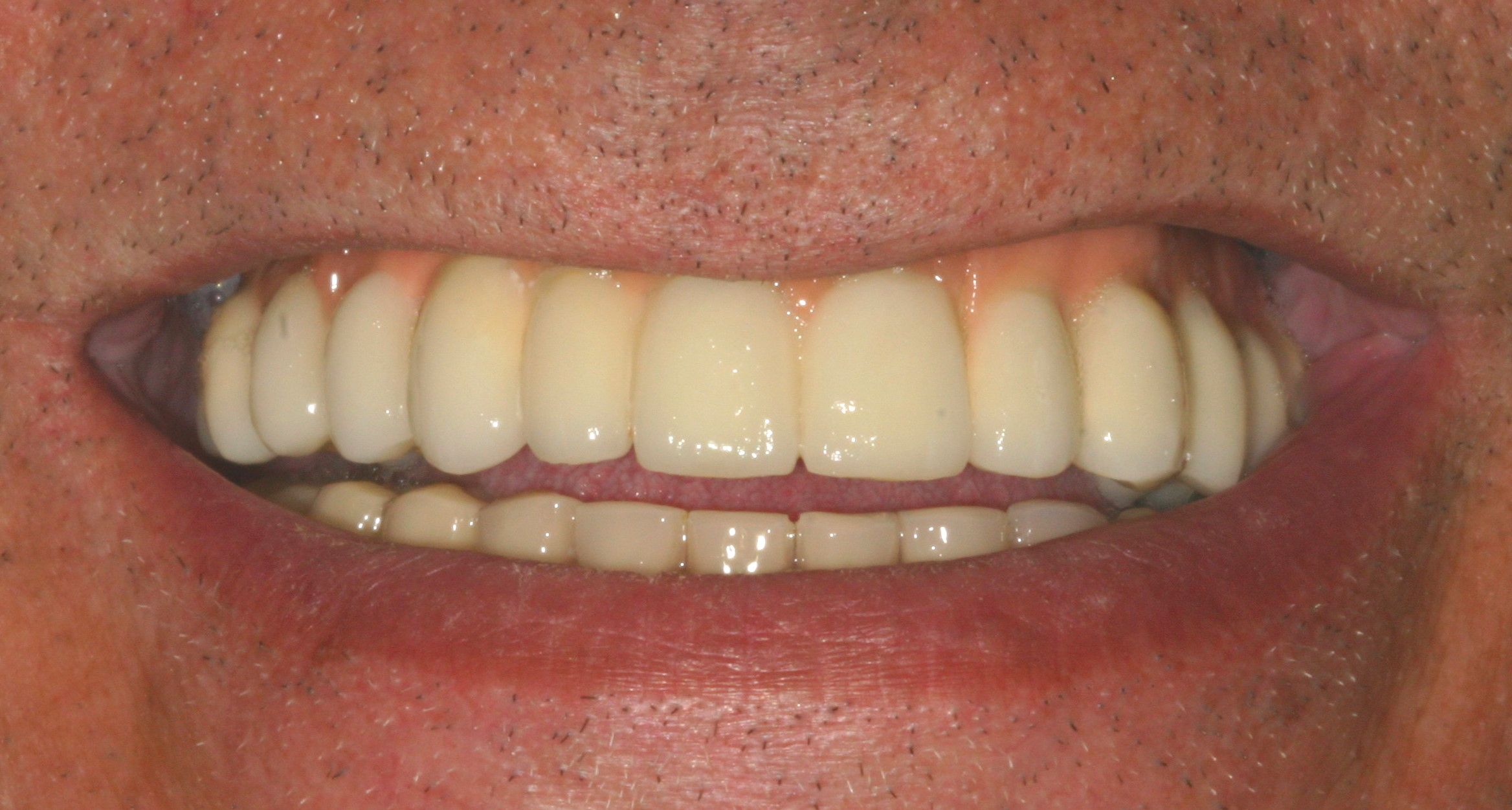 Prótesis total sobre implantes | | Clínica Birbe