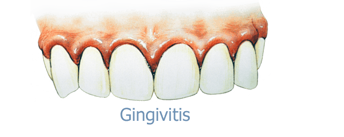 ¿Qué es la gingivitis marginal crónica? | Clínica Birbe